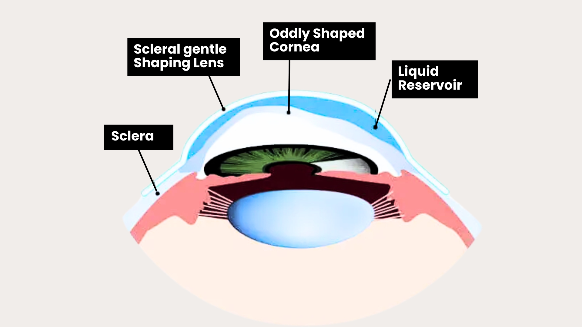 Scleral Lenses | Family Eye Center